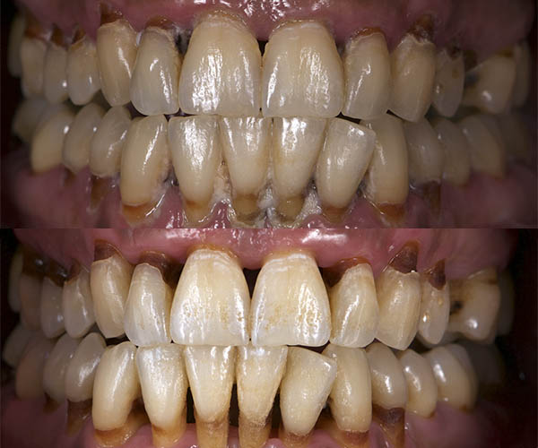 Tratamiento raspado de dientes – Clínica Dental Bruñó & Pilat